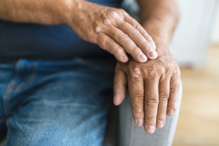 Psoriatic Arthritis: Causes, Symptoms, and Treatment - Orthopaedic ... Psoriatic Arthritis: Causes, Symptoms, and Treatment - Orthopaedic ...